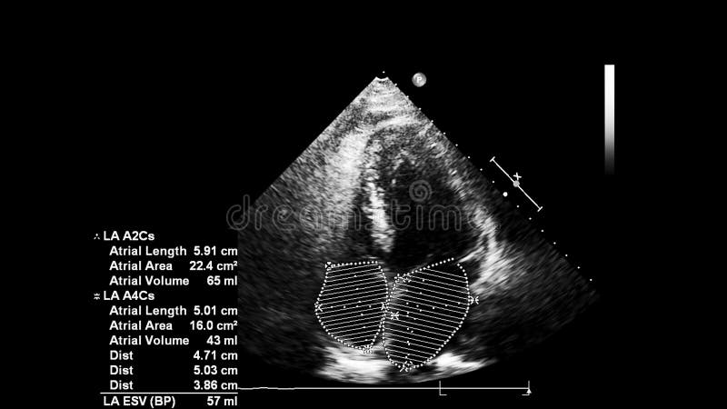 Screen of an Ultrasound Machine with a Heart Image Stock Image - Image ...