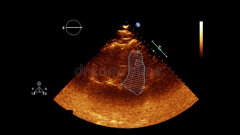Screen of an Ultrasound Machine with a Heart Image Stock Photo - Image ...