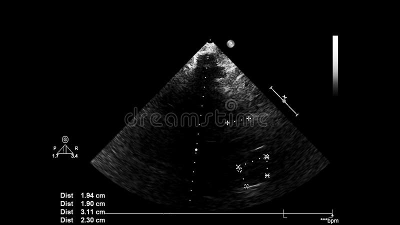 Screen of an Ultrasound Machine with a Heart Image Stock Image - Image ...