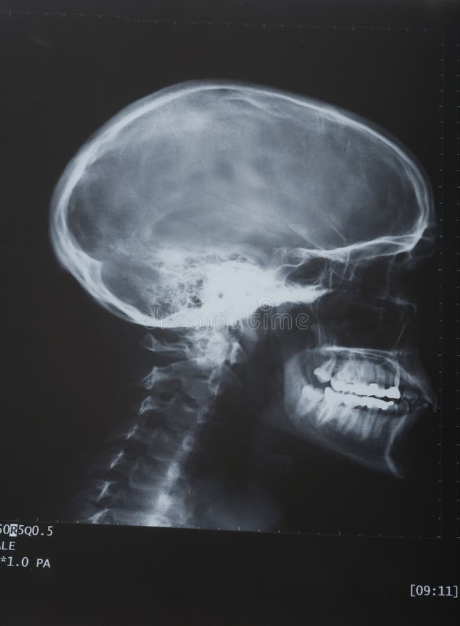 X-Ray Profile stock photo. Image of profile, anatomy, disease - 2087358