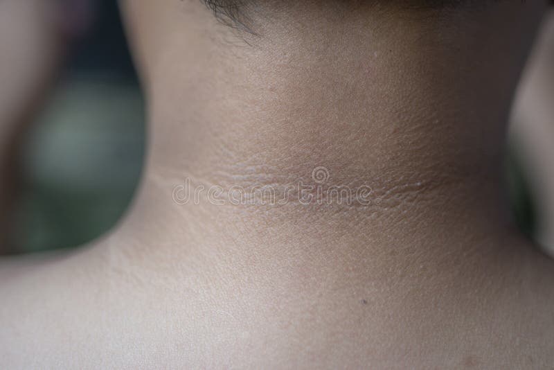 Scurf, Black Marks on the Skin Stock Image - Image of crust, endure ...
