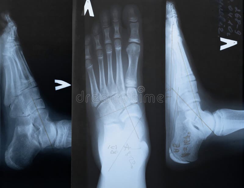 Perro X Ray Mostrando Falanges En Los Pies. Radiografía De Dedos Imagen ...