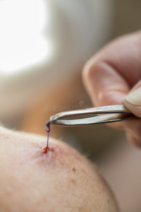 Second Attempt To Remove a Forgotten Retained Suture or Suture Fragment ...