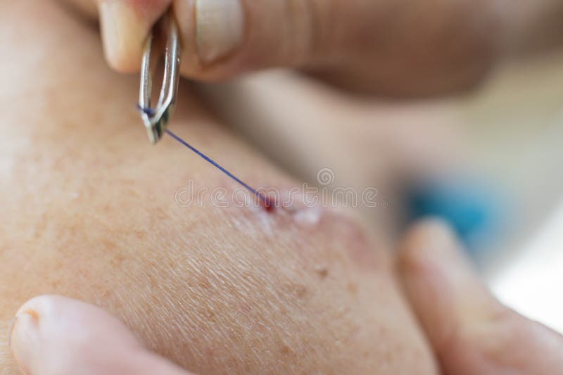 Second Attempt To Remove a Forgotten Retained Suture or Suture Fragment ...