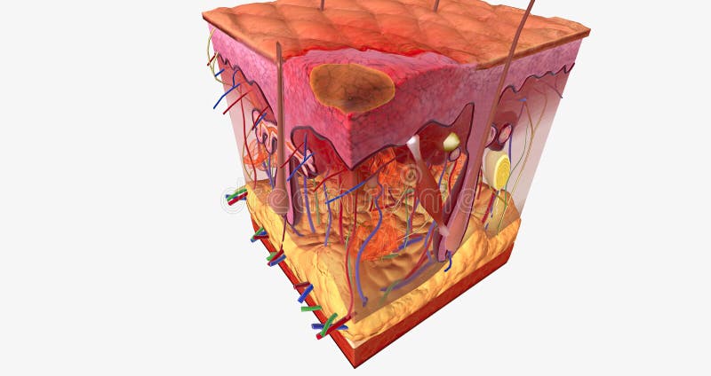 A Second Degree Burn Will Affect the Epidermis and Part of the Dermis ...