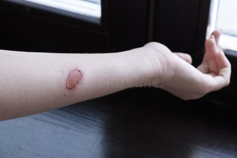 Second Degree Burn of a Woman`s Hand Stock Photo - Image of harming ...