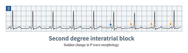 Second Degree Interatrial Block Stock Illustration - Illustration of ...