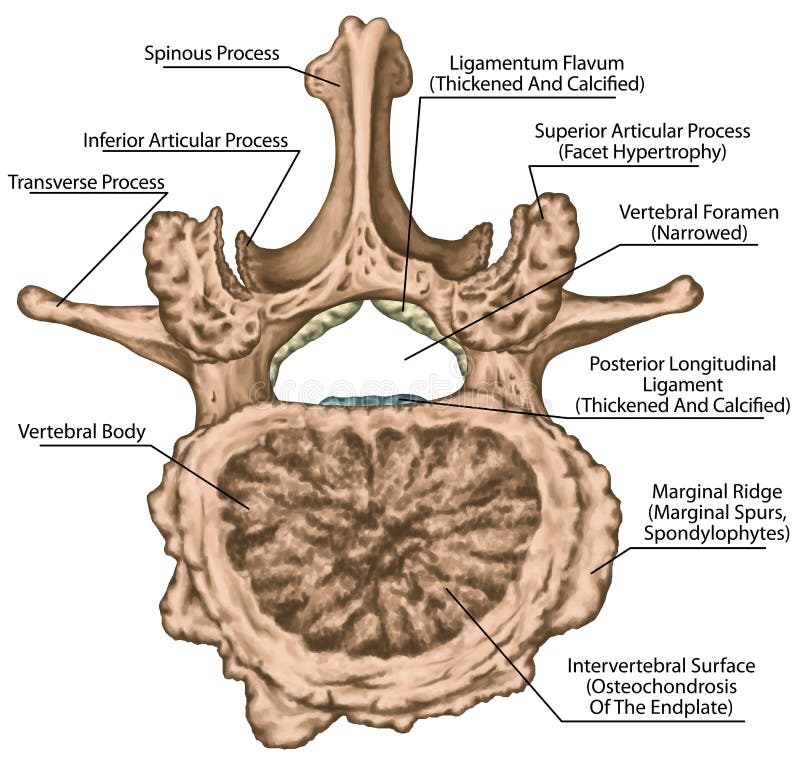 BOARD Advanced Uncovertebral Arthrosis of the Second Lumbar Vertebra ...