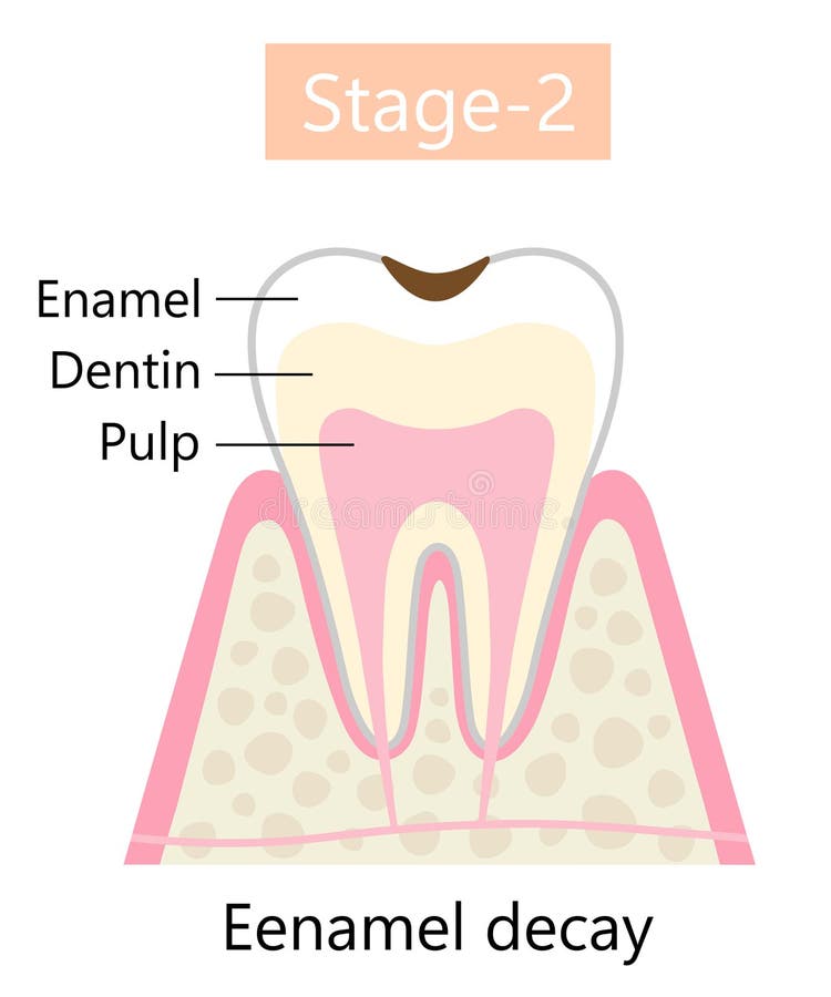 Tooth Decay Symptom, Enamel Decay Results in Dental Cavity Formation ...