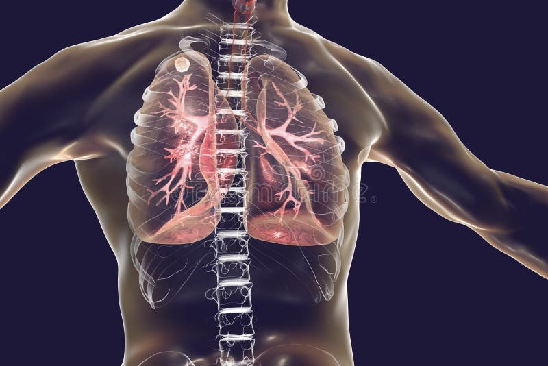 Secondary Tuberculosis in Lungs Stock Illustration - Illustration of ...