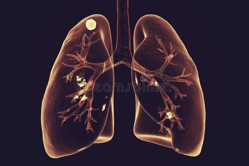 Secondary Tuberculosis in Lungs and Close-up View of Mycobacterium ...