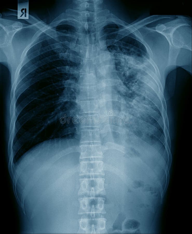 Secretion in lung stock photo. Image of normal, medicine - 123023118