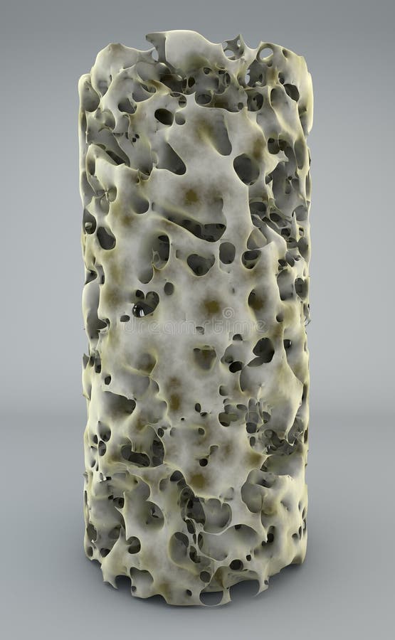 Section of Bone with Osteoporosis Stock Illustration - Illustration of ...