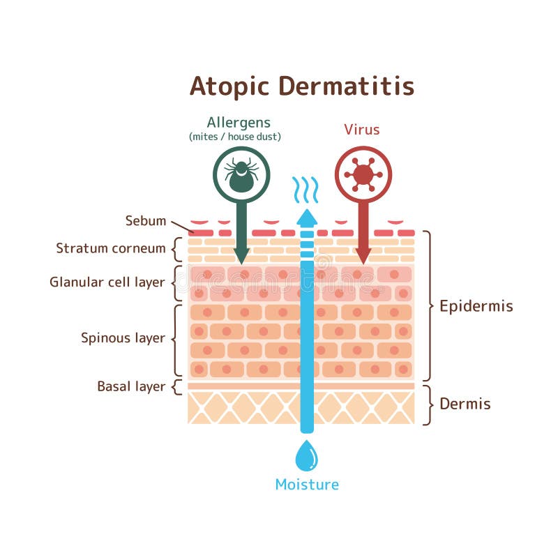 Atopic Dermatitis Atopic Eczema Factors That Cause Disease C Stock