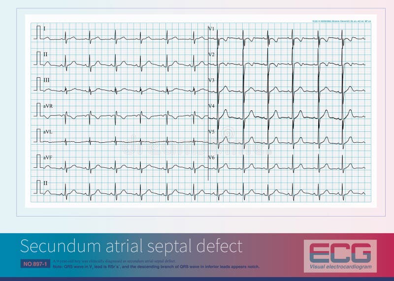 Ventricular Septal Defect Ecg Ventricular Septal Defect (VSD)