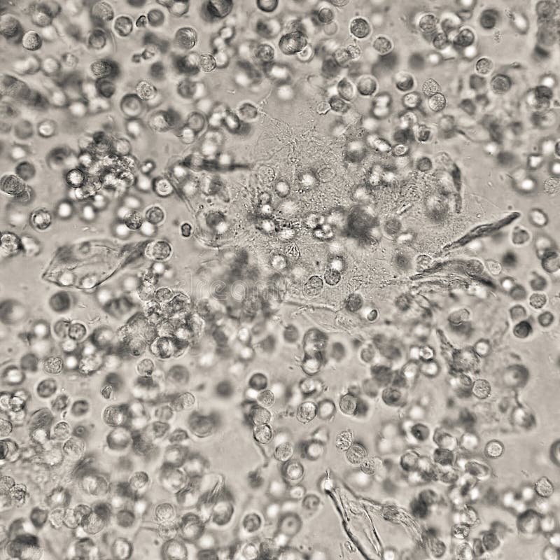 Lots Of Sediment In Urine