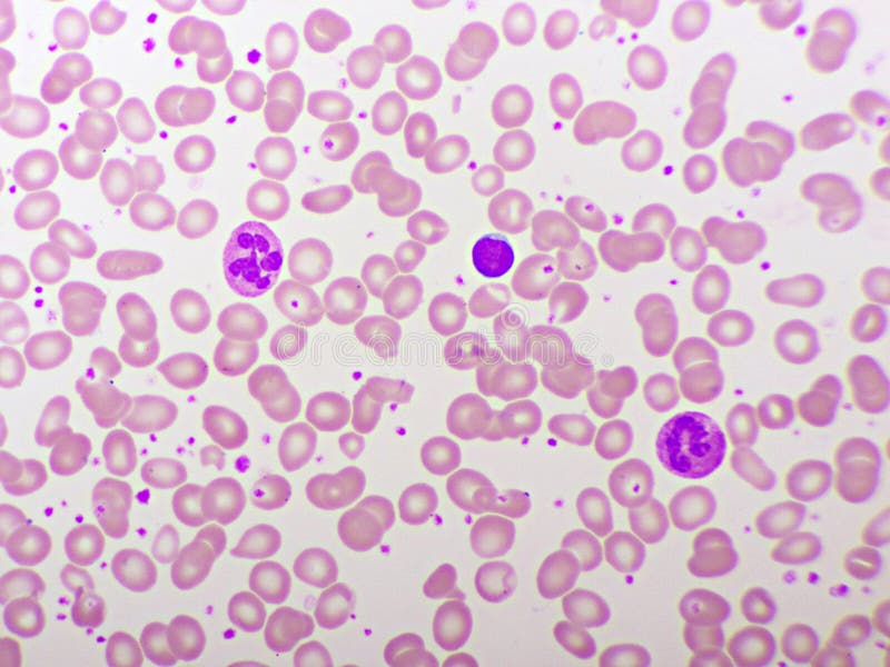 Segmented Neutrophil Cell in Human Blood Smear Stock Photo - Image of ...