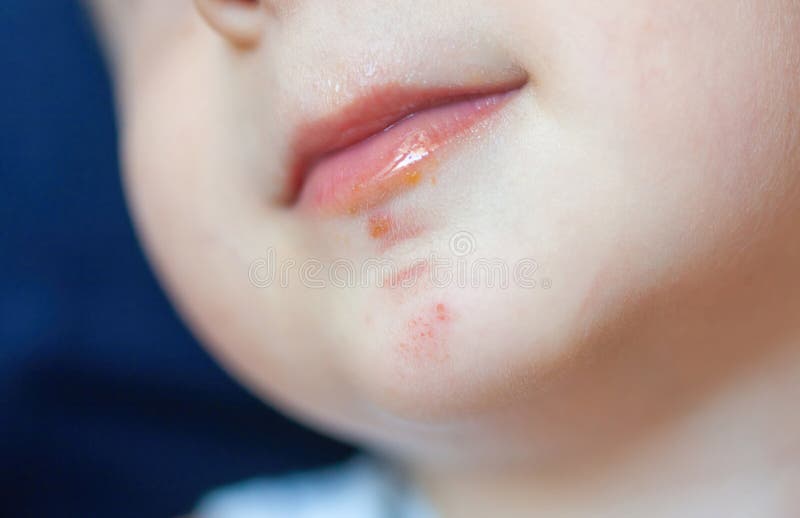 Selective Focus on the Chin of a Young Child. the Chin Has Abrasions ...
