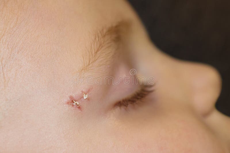 Sutures Eyebrow Stock Photos - Free & Royalty-Free Stock Photos from ...