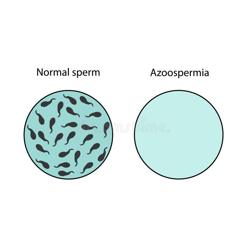 Semen Analysis, Normal Sperm and Azoospermia. Male Reproductive System ...