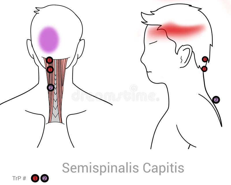 Semispinalis Capitis Trigger Points Can Cause Pain in the Back and Side ...