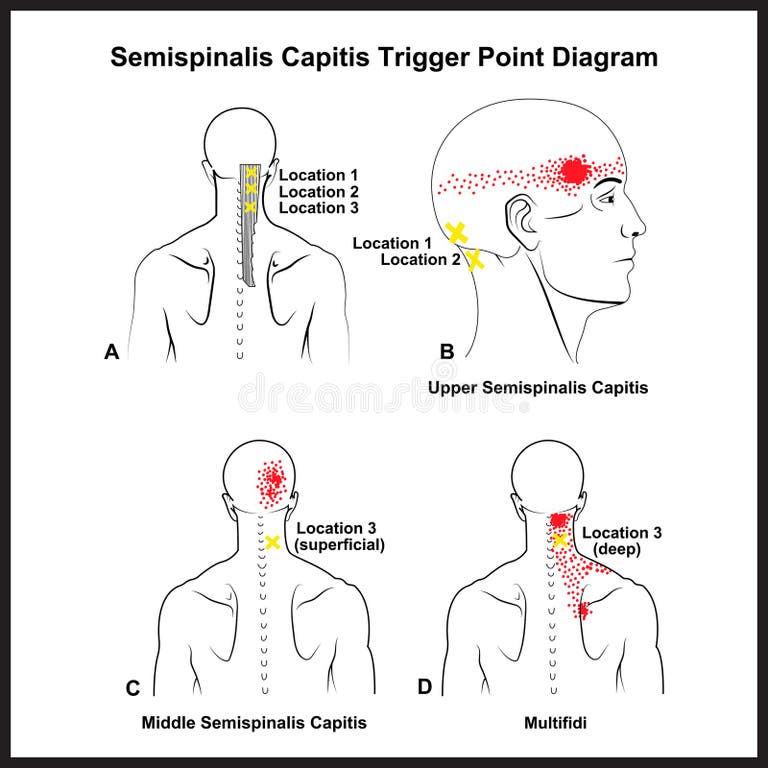 Semispinalis Capitis Trigger Point Diagram Stock Vector - Illustration ...
