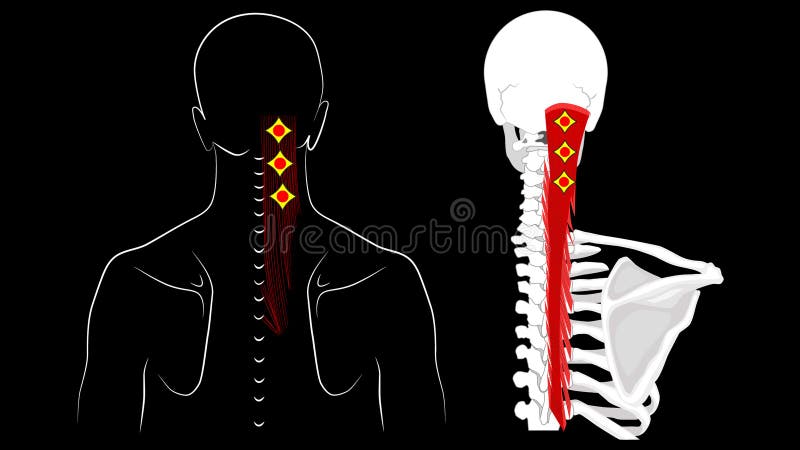 Semispinalis Muscles. Trigger Points. Headache, Neck Pain and Back Pain ...