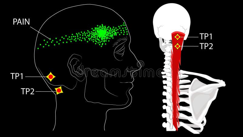 Semispinalis Muscles. Trigger Points and Referred Pain Stock ...