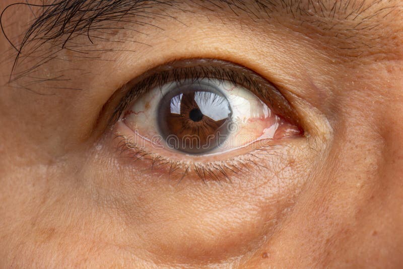 Senior Man Has Cataracts. Generally, Cataracts are Common in Older ...