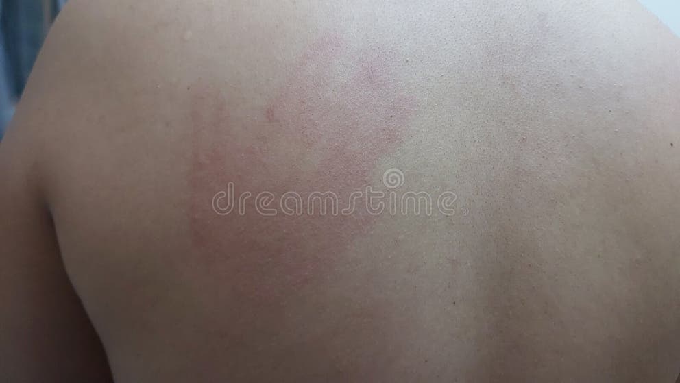 Sensitive Skin and Red Spots on the Back of the Body Stock Photo ...