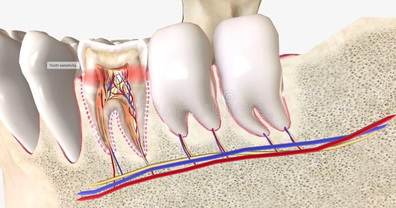 Sensitive Teeth is a Common Dental Condition Characterized by Sharp ...