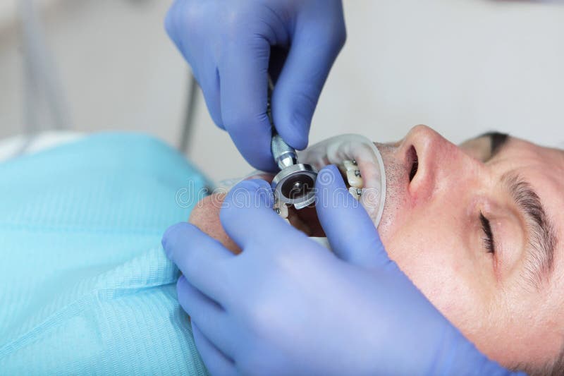 Separation of Teeth. Grinding of Tooth Enamel. Correction and ...