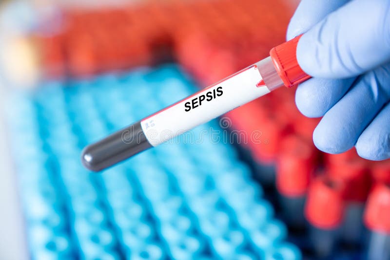 Sepsis. Sepsis Disease Blood Test in Doctor Hand Stock Photo - Image of ...