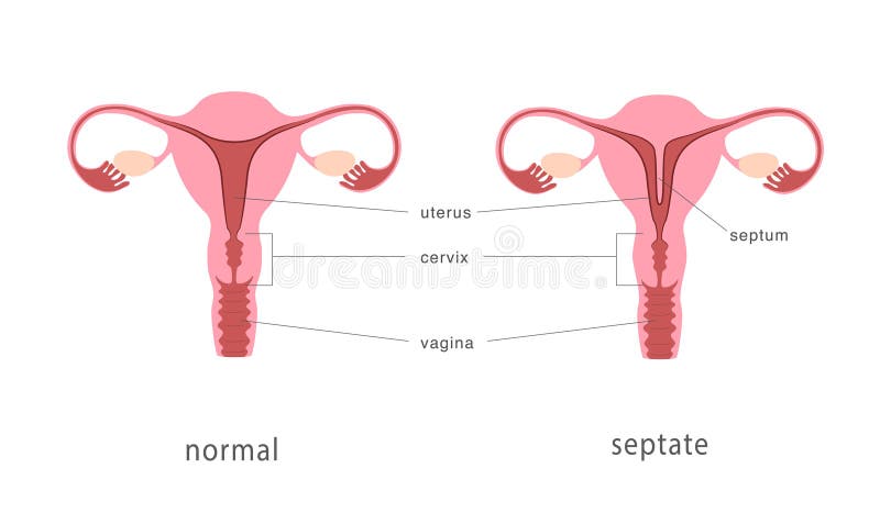 Septate And Normal Human Uterus Structure Uterine Septum As A Congenital Uterine Malformation