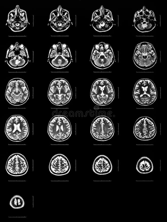 Sequence of Horizontal Sections of a Human Brain Stock Image - Image of ...