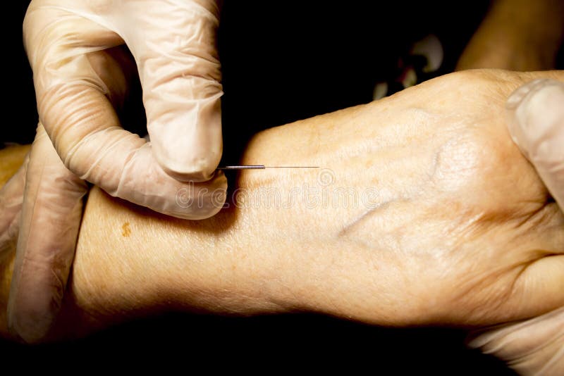 Session acupuncture hands stock photo. Image of acupuncture - 71039184