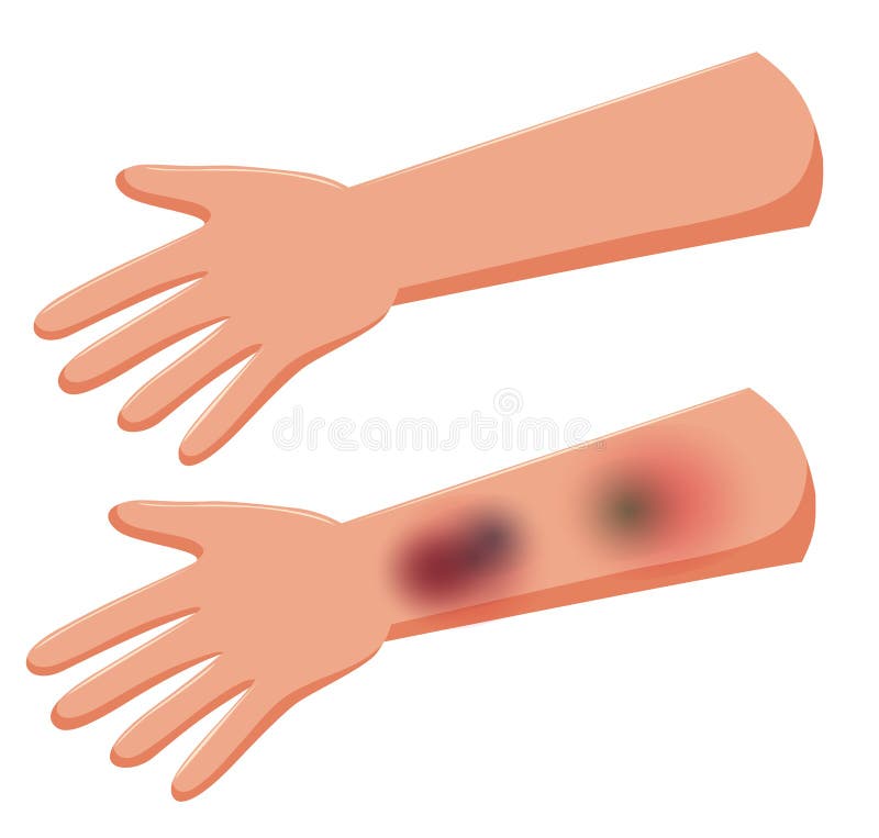 Set of bruising on hands stock vector. Illustration of cartoon - 147799929