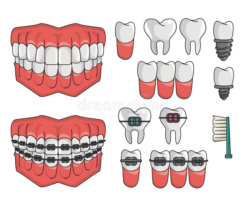 Set of Dental Braces Elements Stock Vector - Illustration of adult ...