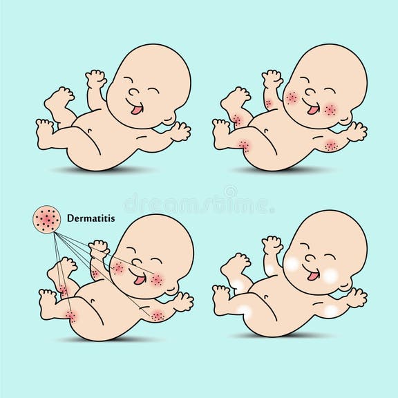 Baby Rash Skin Stock Illustrations – 427 Baby Rash Skin Stock ...