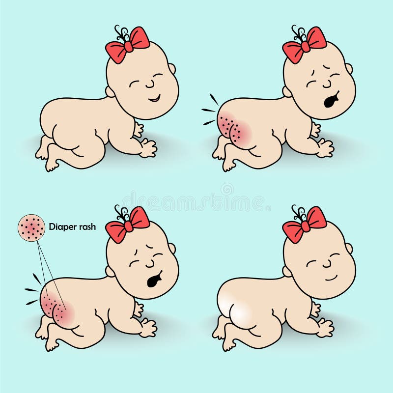 Set diaper rash stock vector. Illustration of health - 67052121