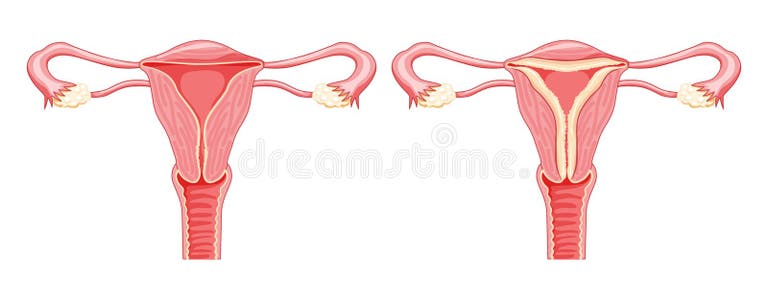 Set of Endometrial Hyperplasia Female Reproductive System in Normal and ...