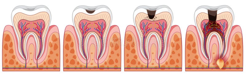 Cavity in a tooth stock vector. Illustration of dental - 121062549
