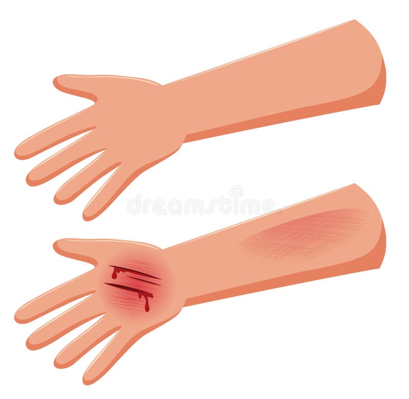 Set of injure hand stock vector. Illustration of cartoon - 142019932
