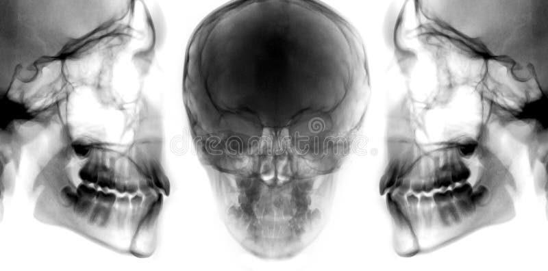 Set of X-ray skull stock image. Image of dental, skeleton - 69574321