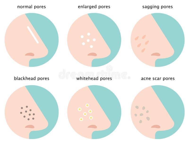 Enlarged Pores. the Structure of the Skin. Wrinkles, Acne Scar. the ... Enlarged Pores. the Structure of the Skin. Wrinkles, Acne Scar. the ...
