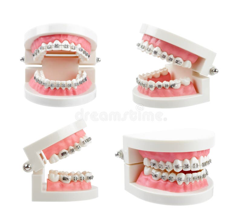 Set of Teeth Model with Metal Wire Dental Braces or Dental Instruments ...