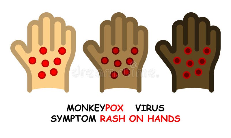 Flat Linear Icons of Monkeypox Symptom "rash on Hands" Stock Vector ...