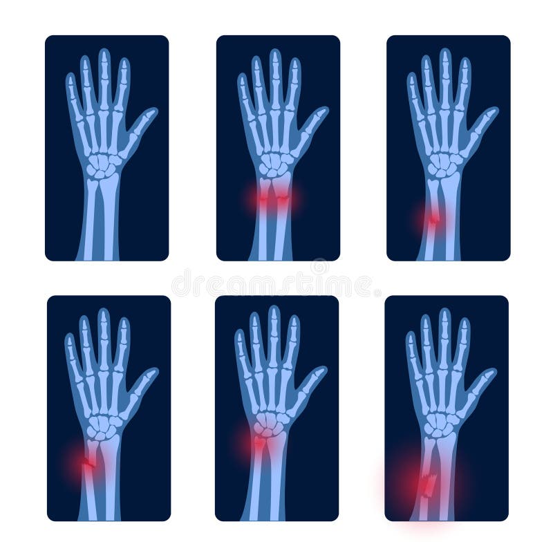 Open Fracture Stock Illustrations – 243 Open Fracture Stock ...