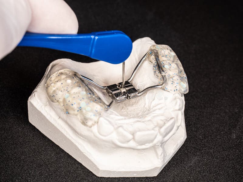 Setting of Braces with Expansion on Teeth Stock Image - Image of gloves ...