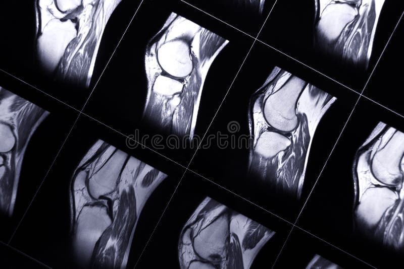 Images of an Arthroscopy of the Knee Stock Image - Image of diagnostics ...
